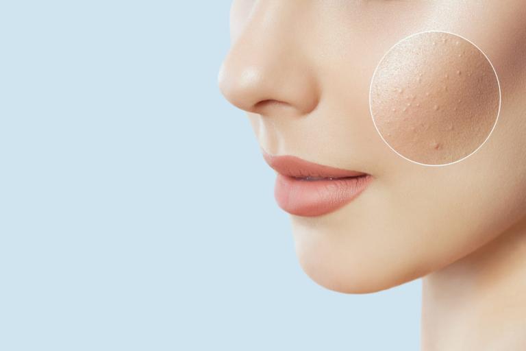 Dermatite sul viso: sintomi, cause e come riconoscerla